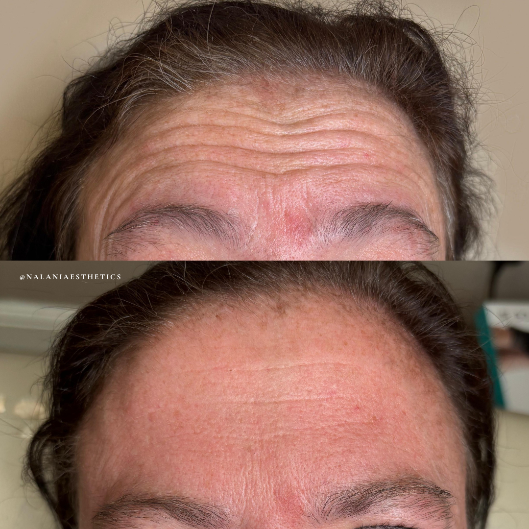 ANTI-WRINKLE TREATMENTS – Nalani Aesthetics